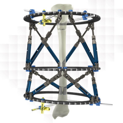 Fixadores Externos Smart Correction®, Unix HTO Fixator, Unix Rail